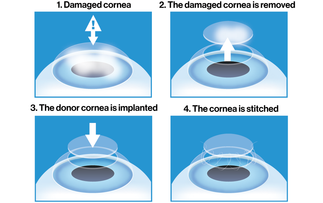 Corneal Transplant Or Keratoplasty How Is The Operation